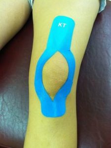 Taping Technique : Physiotherapy Treatment Technique