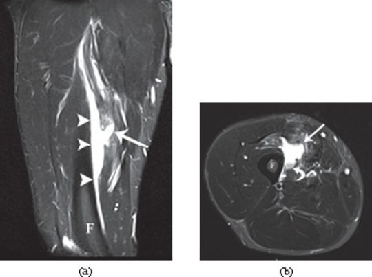 Quadriceps Strain Contusions Assessment Diagnosis