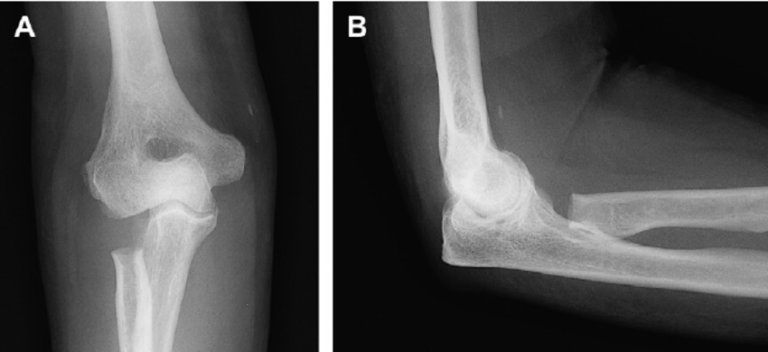 Total Elbow Replacement: Cause, Type, Procedure,Physiotherapy Exercise