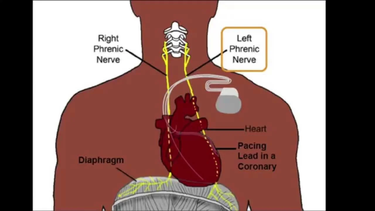Phrenic Nerve Phrenic Nerve