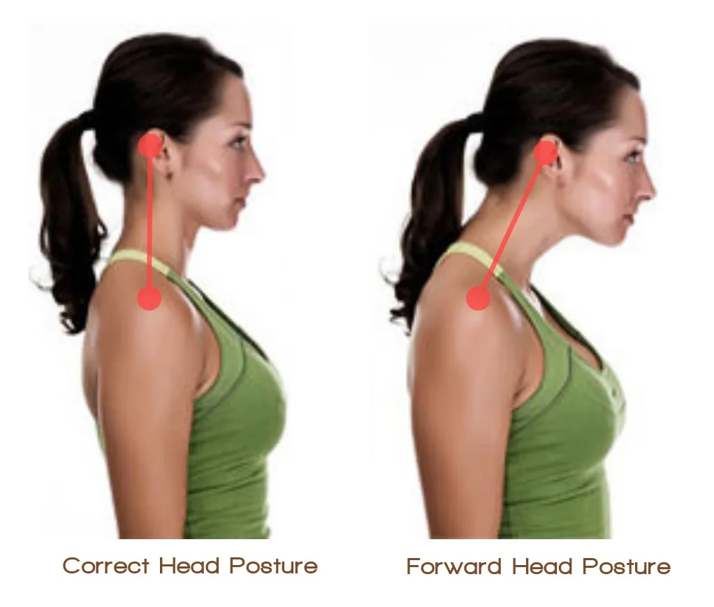 Neck Pain Due to Bad Posture - Cause, Symptoms, Treatment